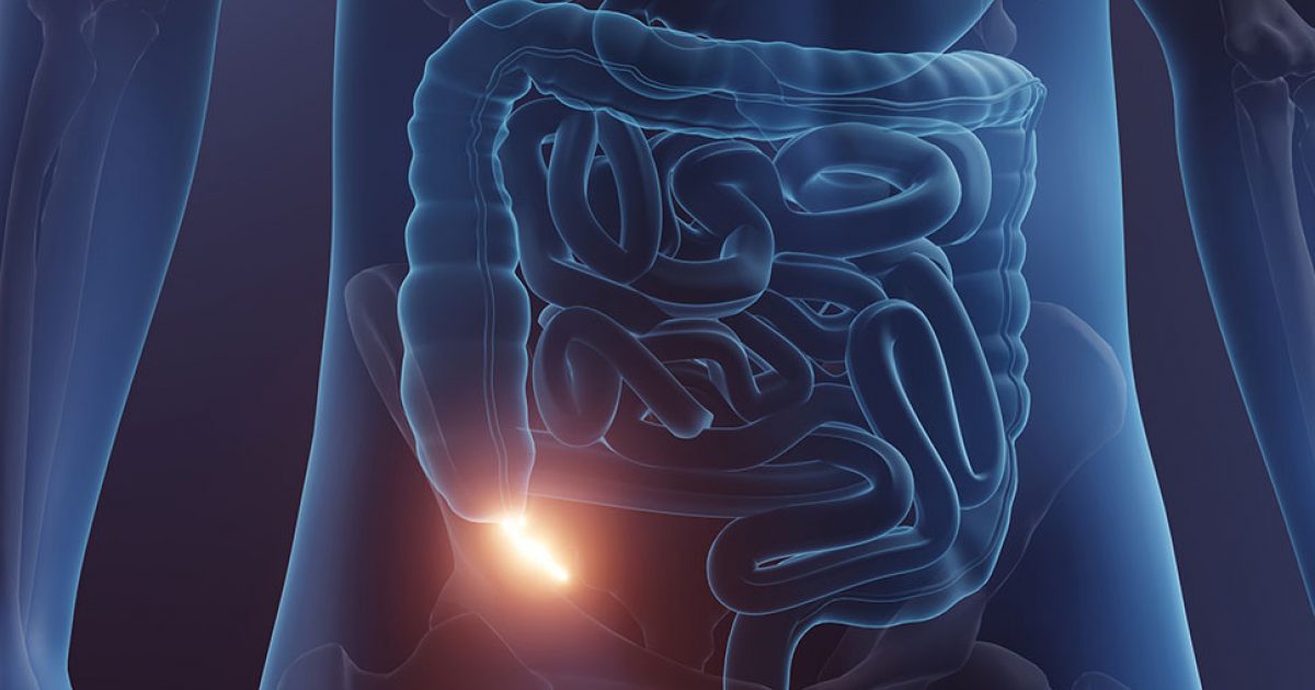 Early Preoperative Antibiotics Before Appendectomy | Clinician.com