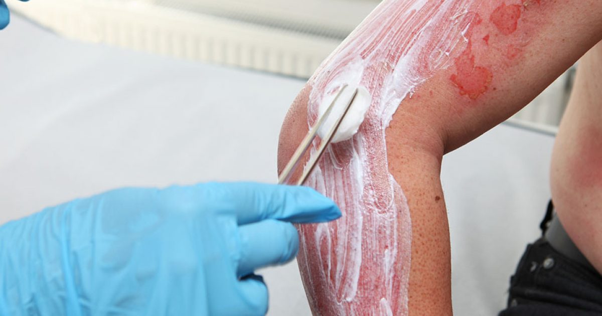 Evaluation and Management of Burn Injuries | Clinician.com