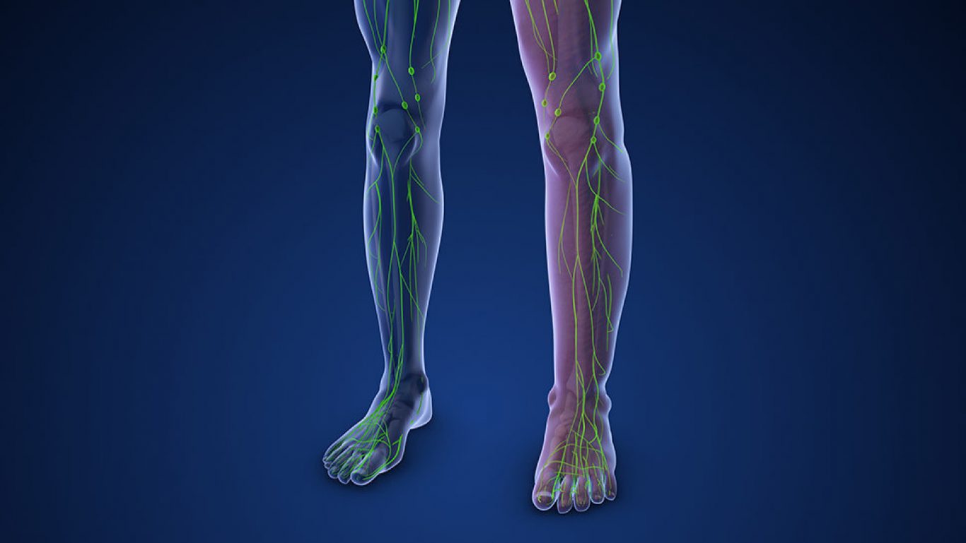 Lymphedema Risk After Pelvic Sentinel Lymph Node… | Clinician.com