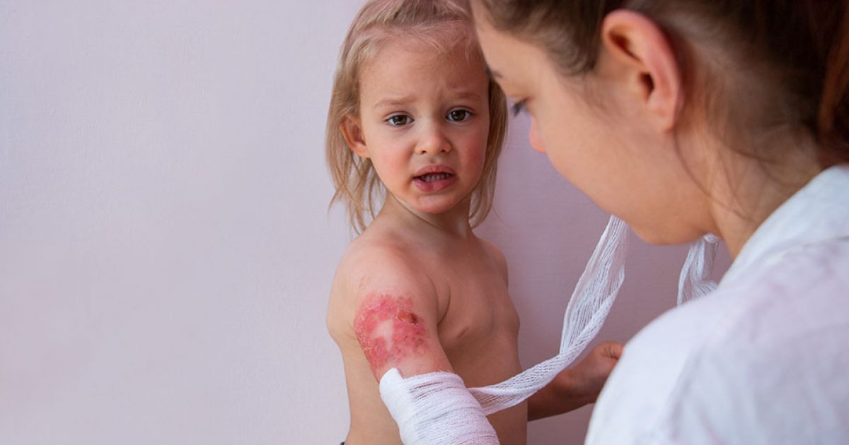 Pediatric Burn Care: Strategies for Identification… | Clinician.com
