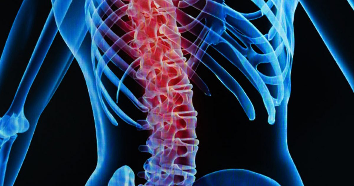 Spinal Cord Compression | Clinician.com