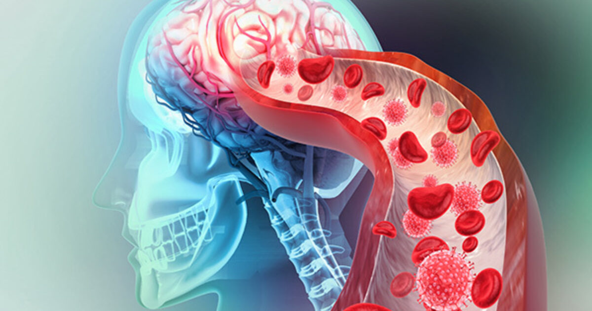 Statins Might Lower Risk of Recurrent Stroke | Clinician.com