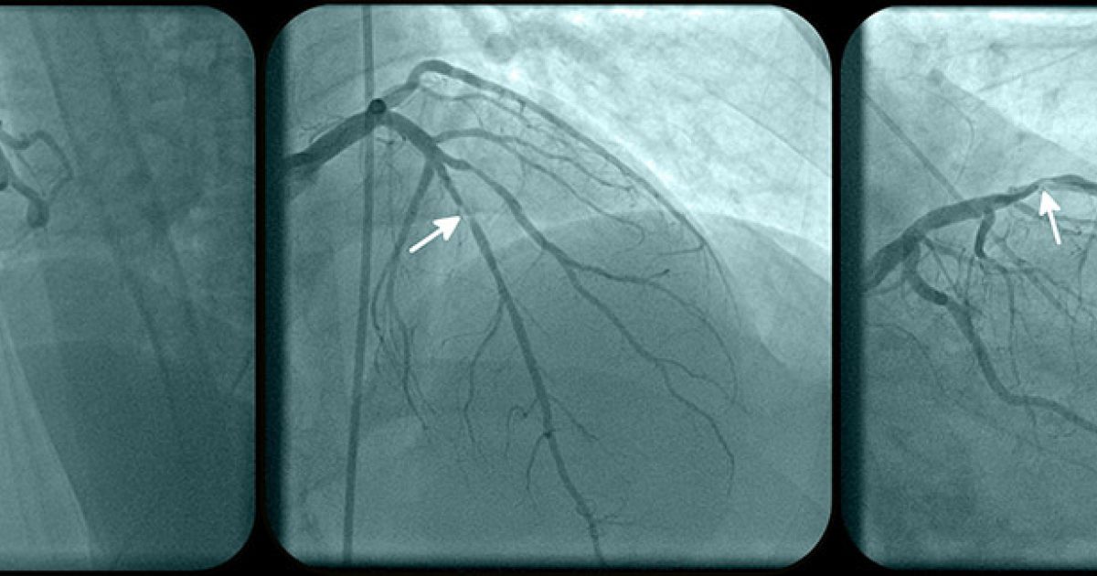 Angiography-Based QFR Analysis Falls Short Compared… | Clinician.com