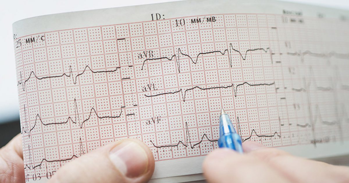 Arrhythmias in the Holiday Heart Syndrome | Clinician.com