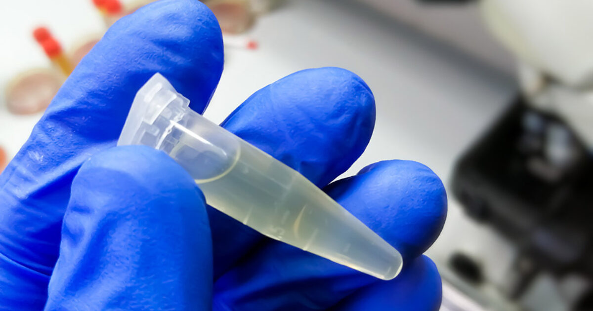 CSF Analysis May Help in the Diagnosis of Dementia… | Clinician.com