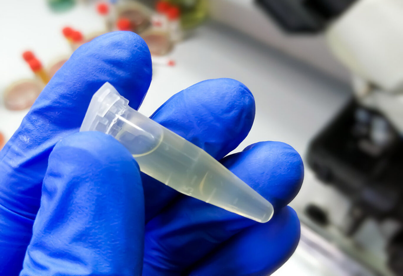 CSF Analysis May Help in the Diagnosis of Dementia… | Clinician.com