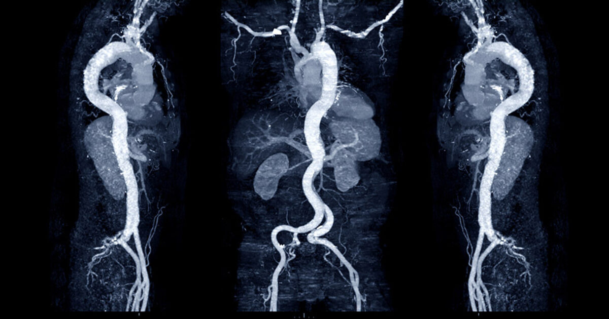 Does Ascending Aorta Size Predict Dissection? | Clinician.com