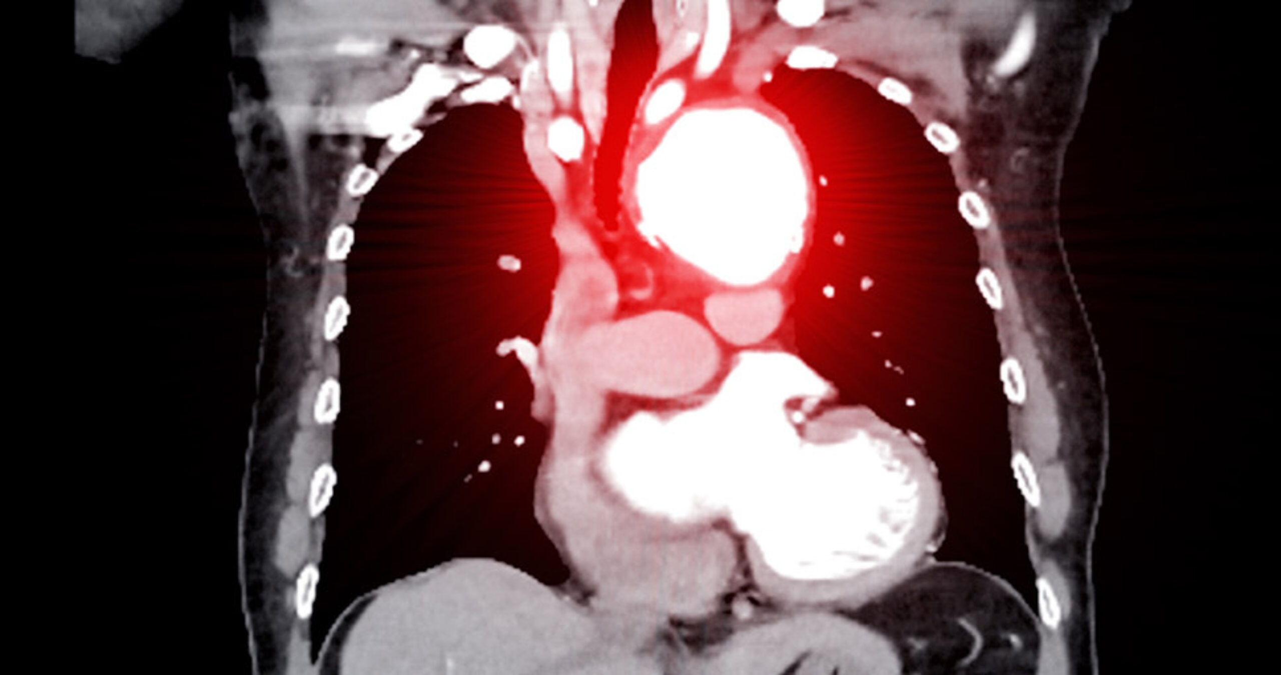 Clarifying the Risk of Aortic Aneurysm Development | Clinician.com