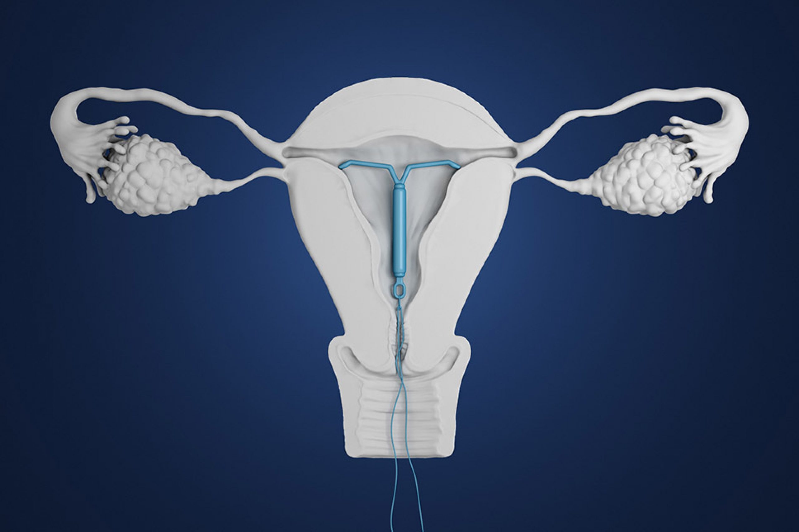 Intrauterine Instillation of Mepivacaine at the… | Clinician.com