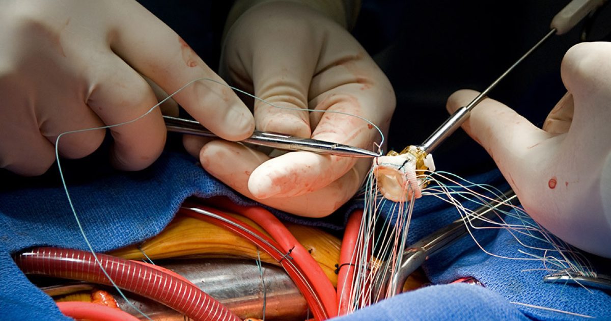 PCI in TAVR Patients with Severe Coronary Lesions… | Clinician.com