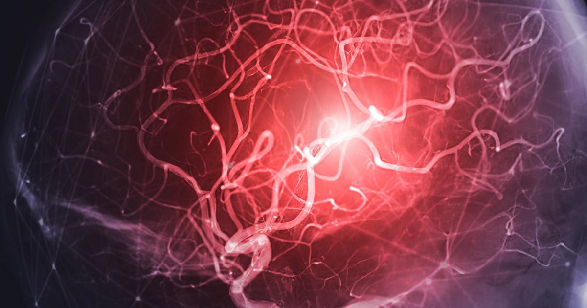 TIA Is Associated with Accelerated Cognitive Decline | Clinician.com