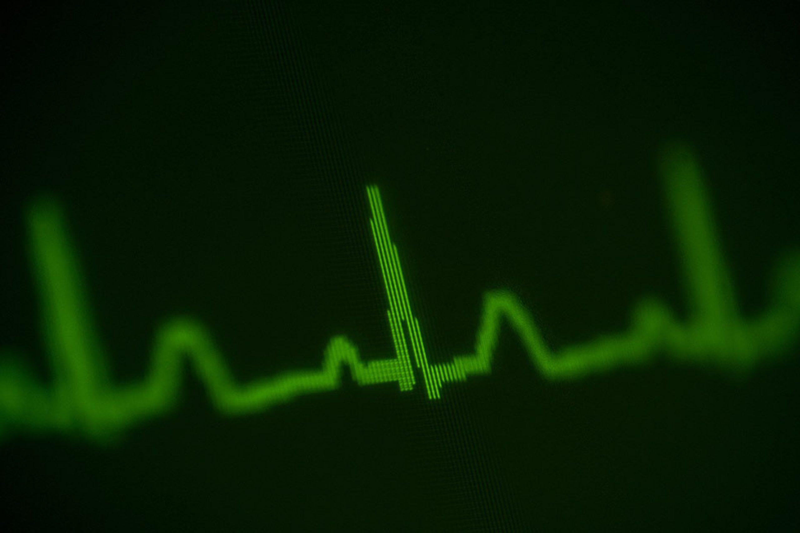 Withdrawing Heart Failure Medications After Restoring… | Clinician.com