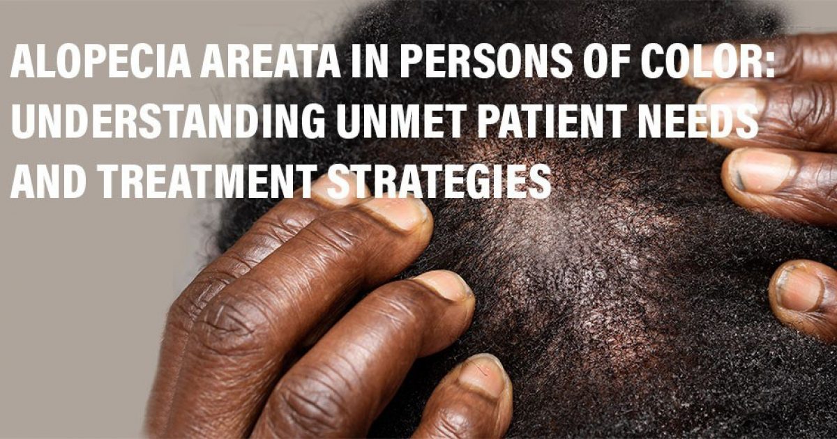 Alopecia Areata in Persons of Color: Understanding… | FreeCME.com